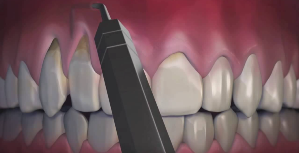 Pinhole-Surgical-Technique-Vancouver - VDSC