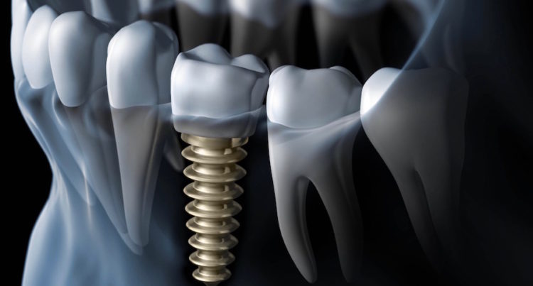 Causes of Dental Implant Failure - What You Need to Know