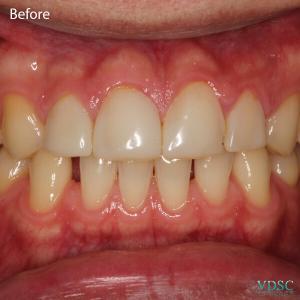 upper-front-teeth-crowns_2b1 - VDSC