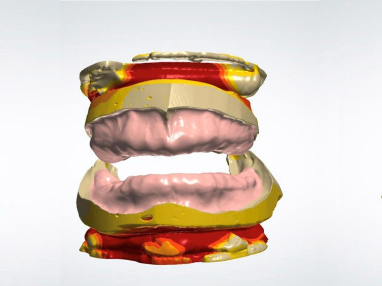 What Are Digital Dentures and How They Work? - VDSC