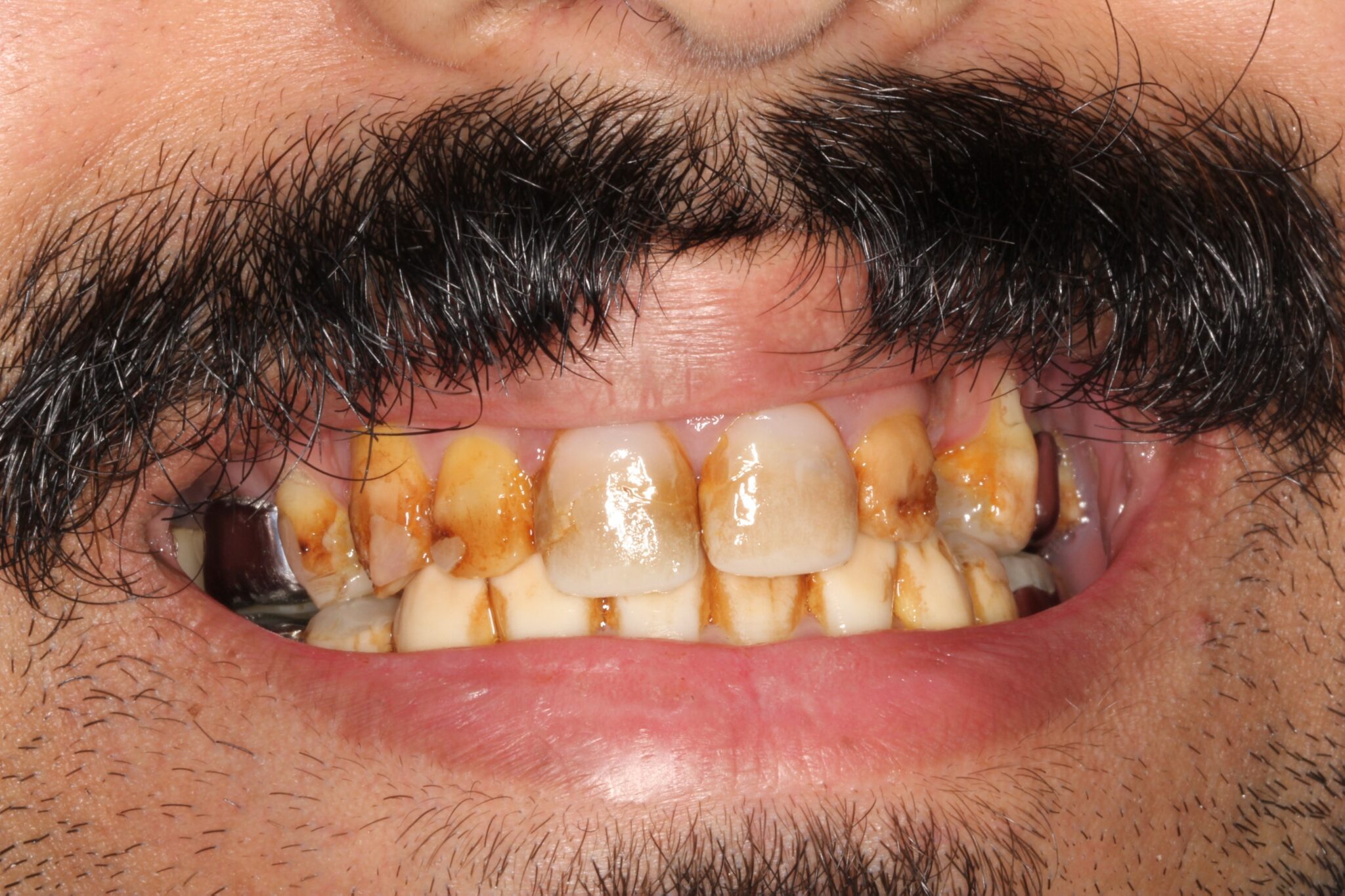 Malformed Teeth: Causes, Treatments & Prevention Strategies